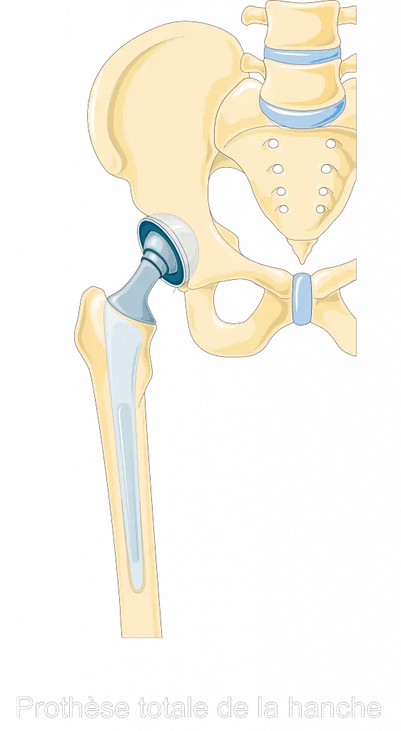 Can You Use An Inversion Table With A Hip Replacement