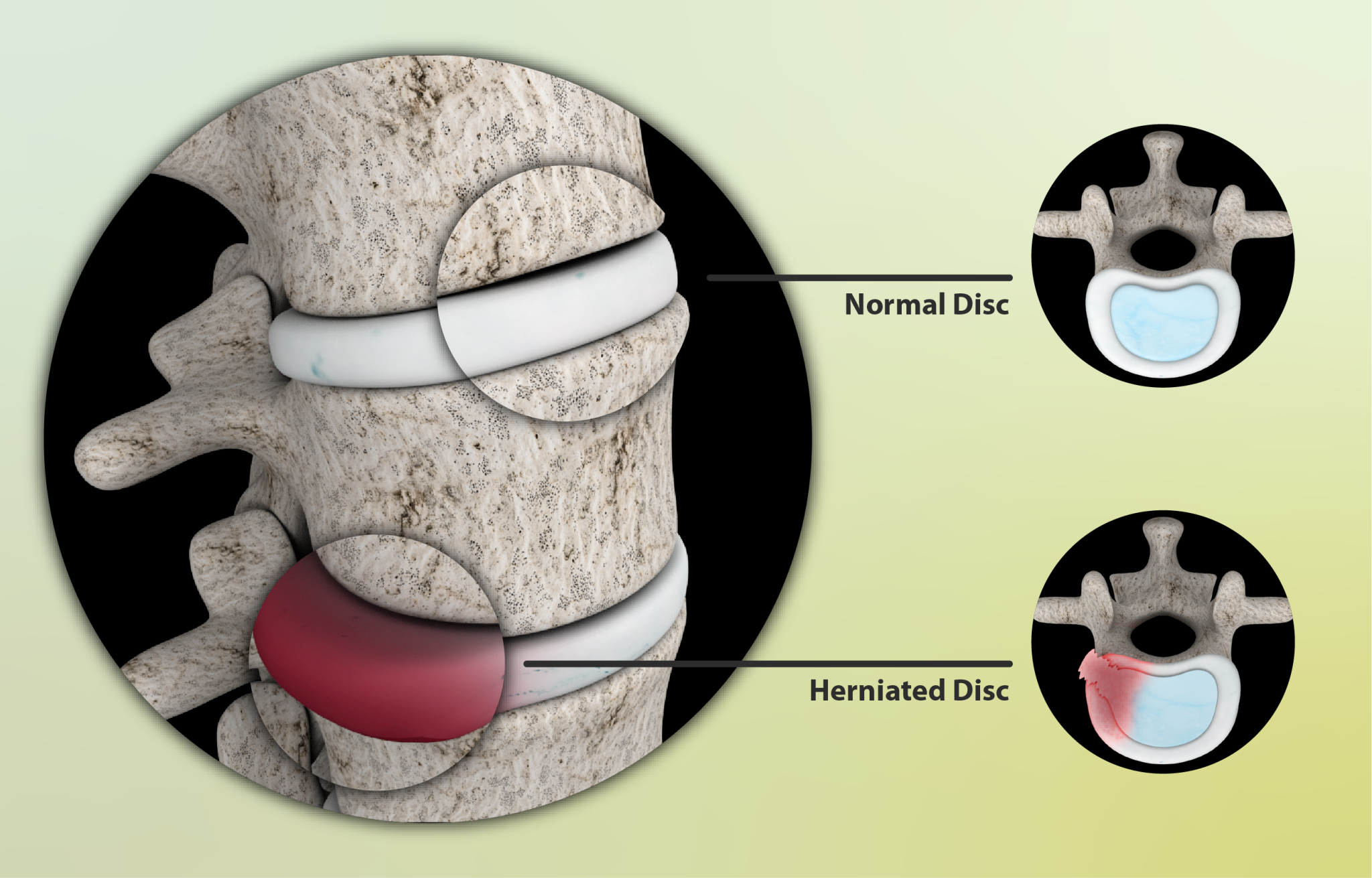 Is A 10mm Herniated Disc Big-Disc Herniation